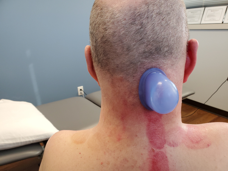 Needling and Cupping in Neck and Upper Trapezius for SMA Patients – HCP ...